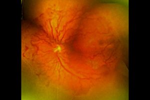 Prevention, detection, documentation, and treatment of retinopathy of ...